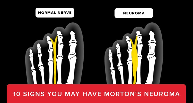 Signs You May Have Morton's Neuroma | Read How To Know it – EASYFEET ...